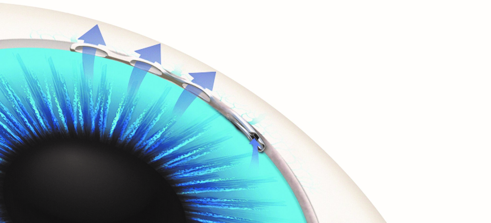 Getting Off Eye Drops When You Have Glaucoma - Fichte, Endl & Elmer Eyecare