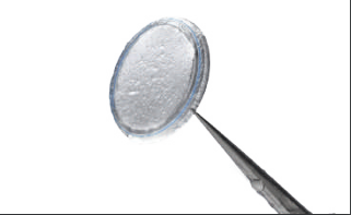 Could Prokera Help My Dry Eye Symptoms? | Fichte, Endl & Elmer